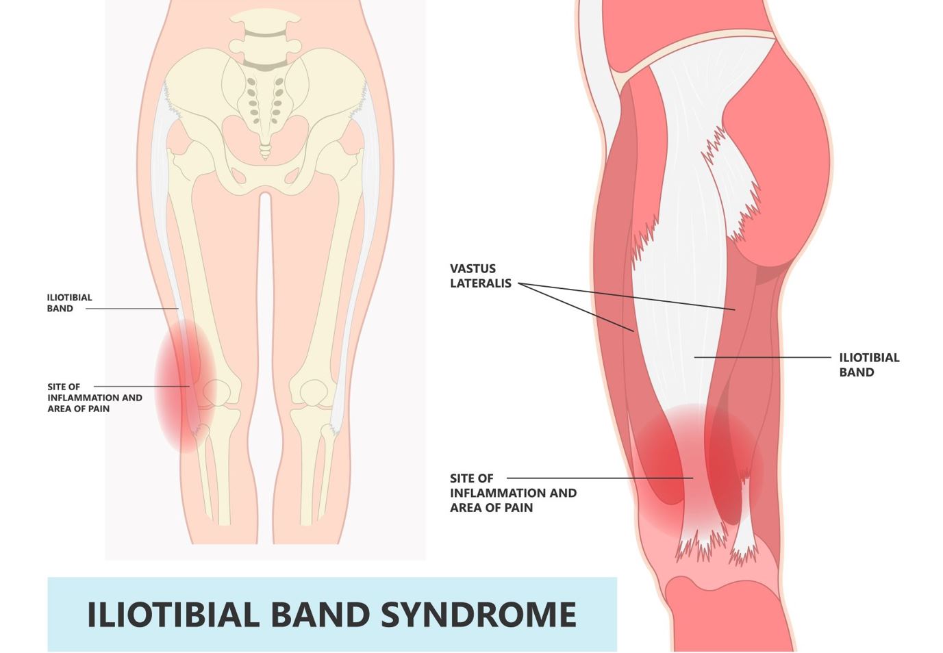 髂胫束综合征 (ITBS) 的管理 - 海峡足科诊所