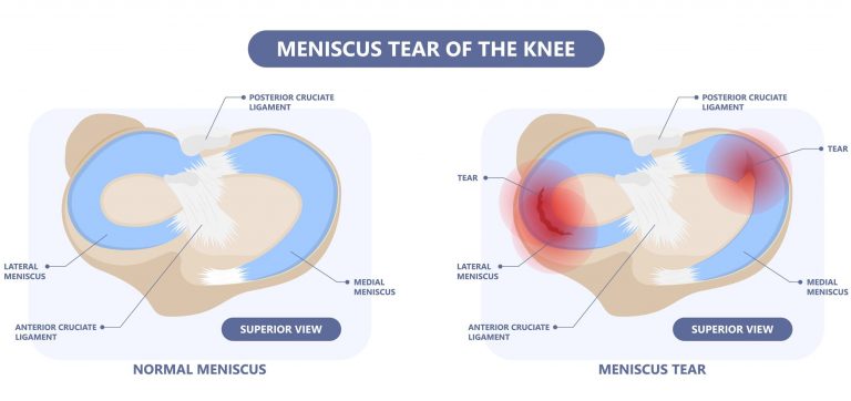 Meniscus Tear | Causes & Management - Straits Podiatry