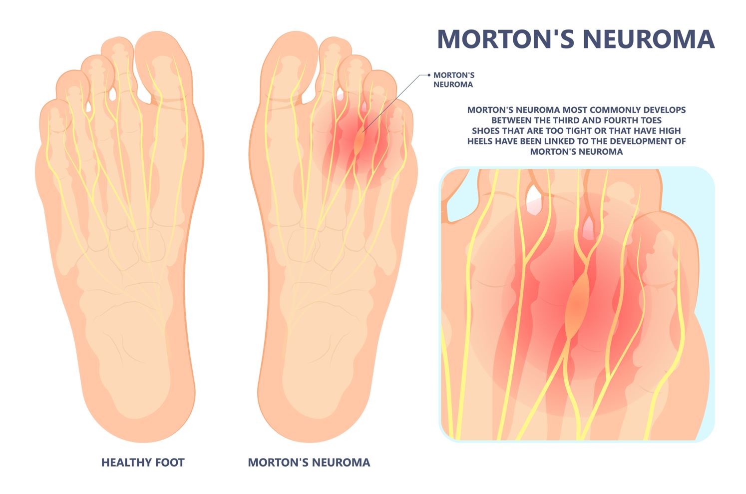 Understanding Morton’s Neuroma | Straits Podiatry Singapore