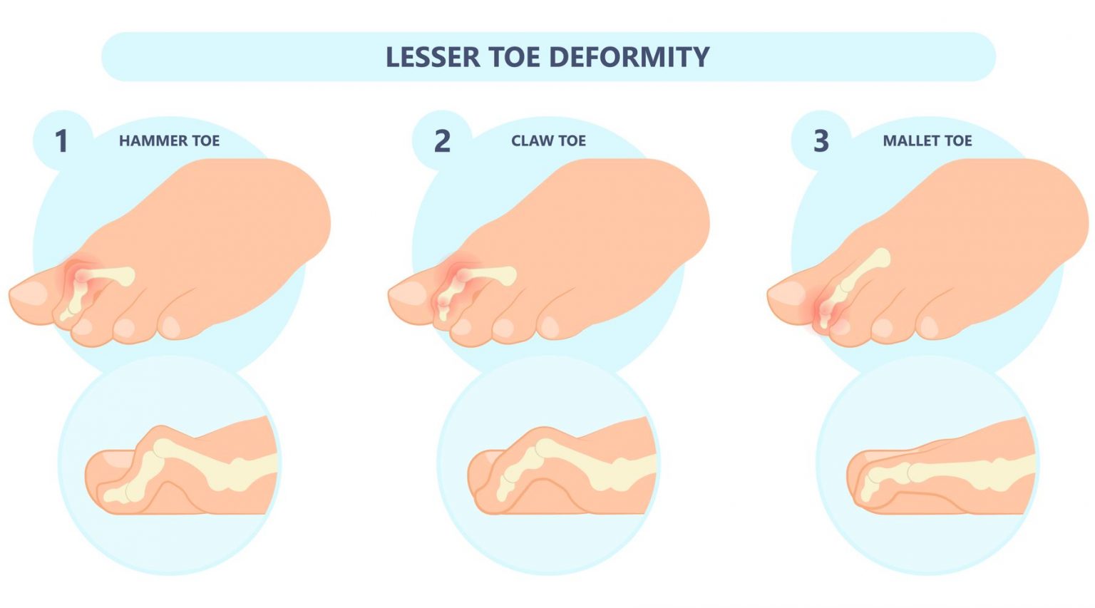 Clawed and Hammer Toes | Causes | Management- Straits Podiatry