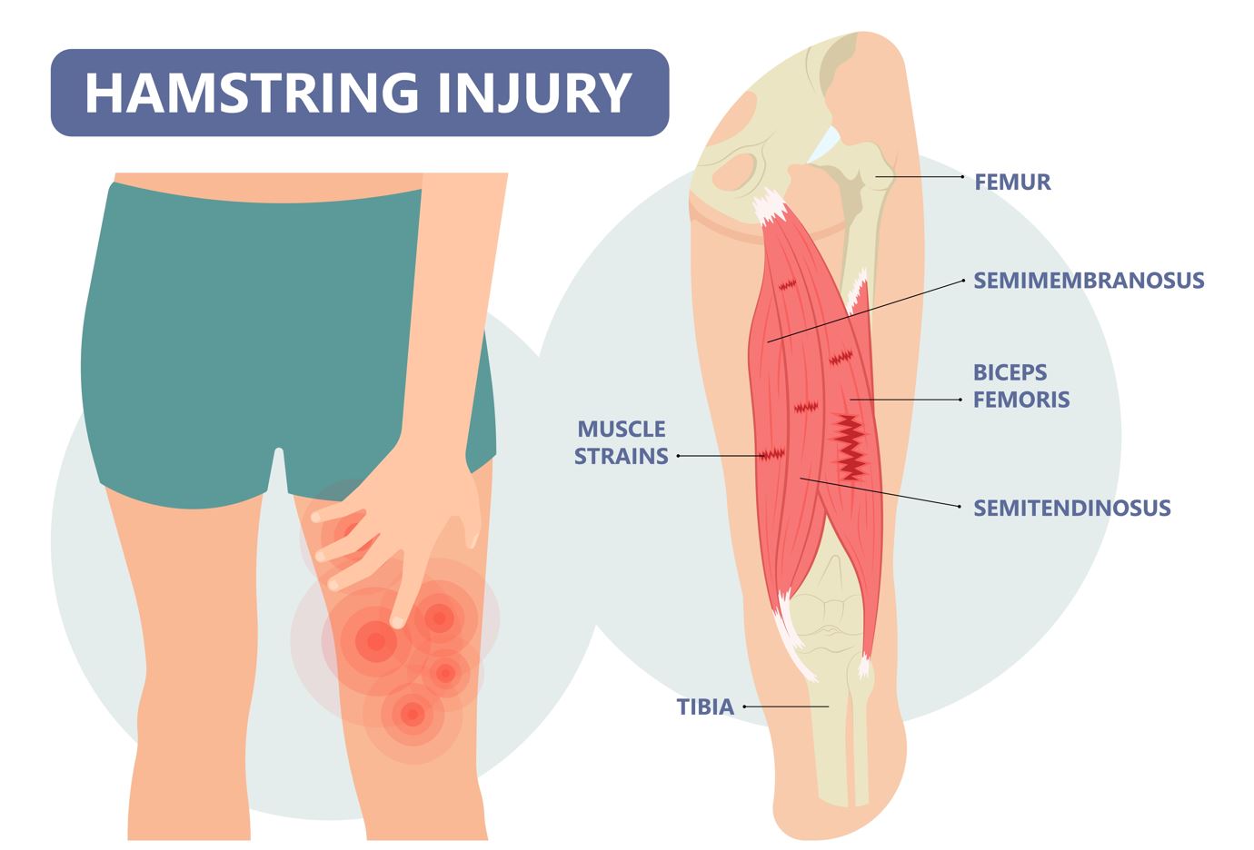Hamstring Strain Management In Singapore Straits Podiatry