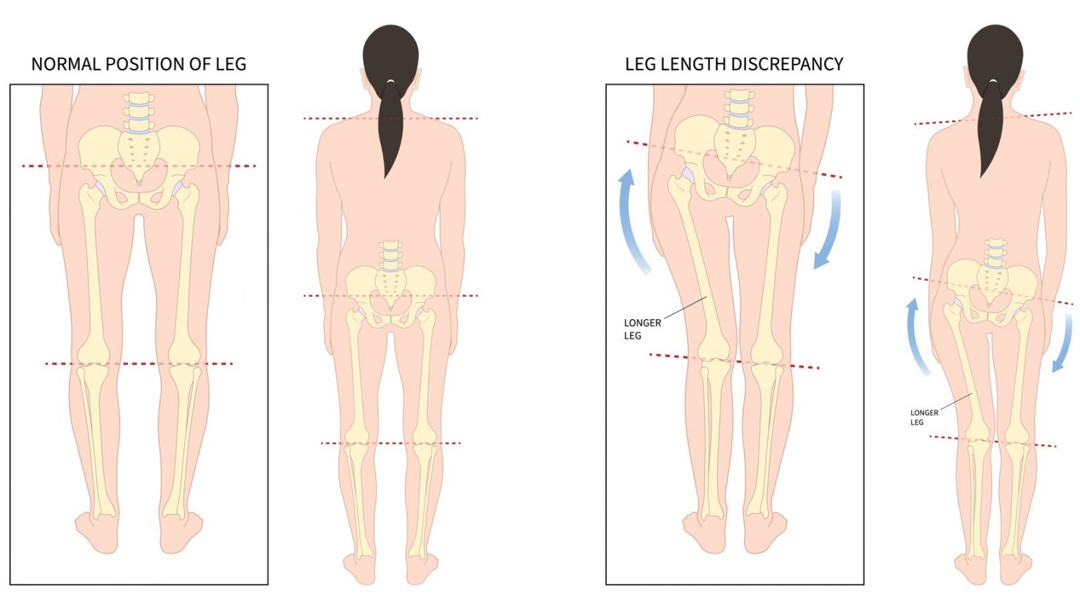 Leg Length Discrepancy | Causes & Management - Straits Podiatry