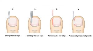 Partial Nail Avulsion Procedure | Straits Podiatry Singapore