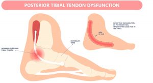 Posterior Tibial Tendon Dysfunction Treatment - Straits Podiatry
