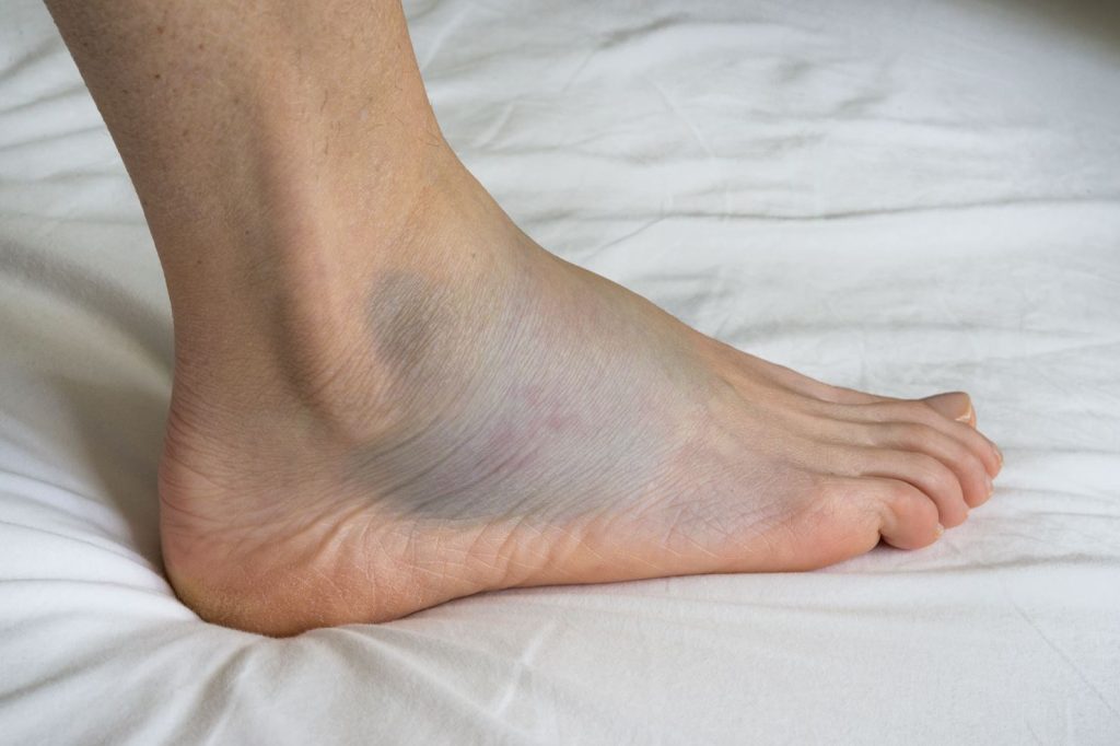 5 Most Common Foot and Ankle Injuries - Straits Podiatry