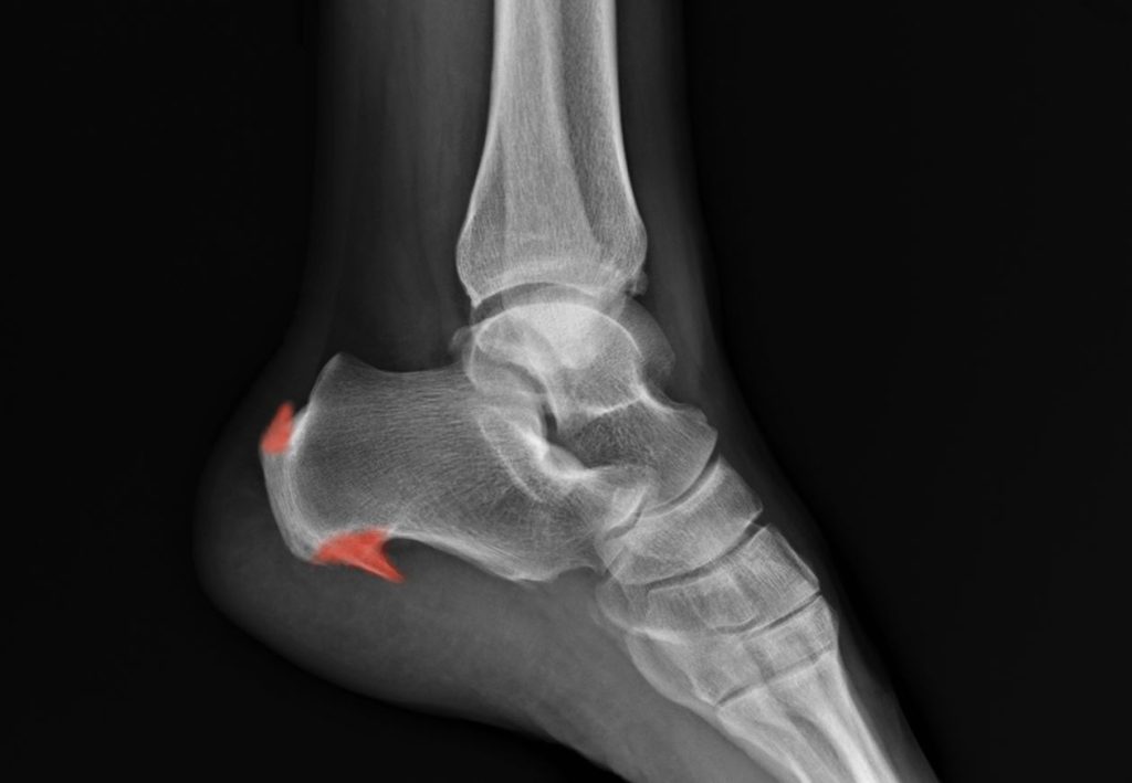 Why Do I Have Heel Pain? - Straits Podiatry