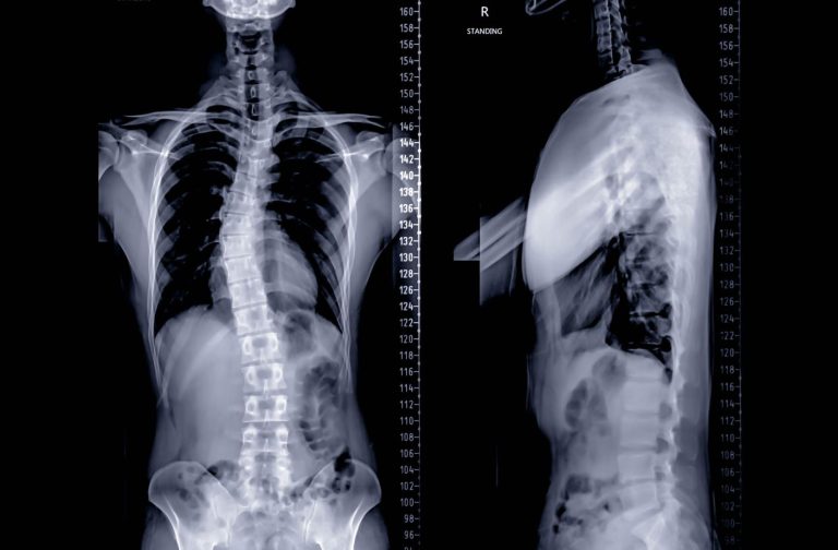 Malalignment Syndrome - Causes & Management- Straits Podiatry