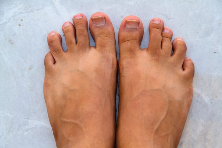 Curly Toe Syndrome: How To Manage? - Straits Podiatry